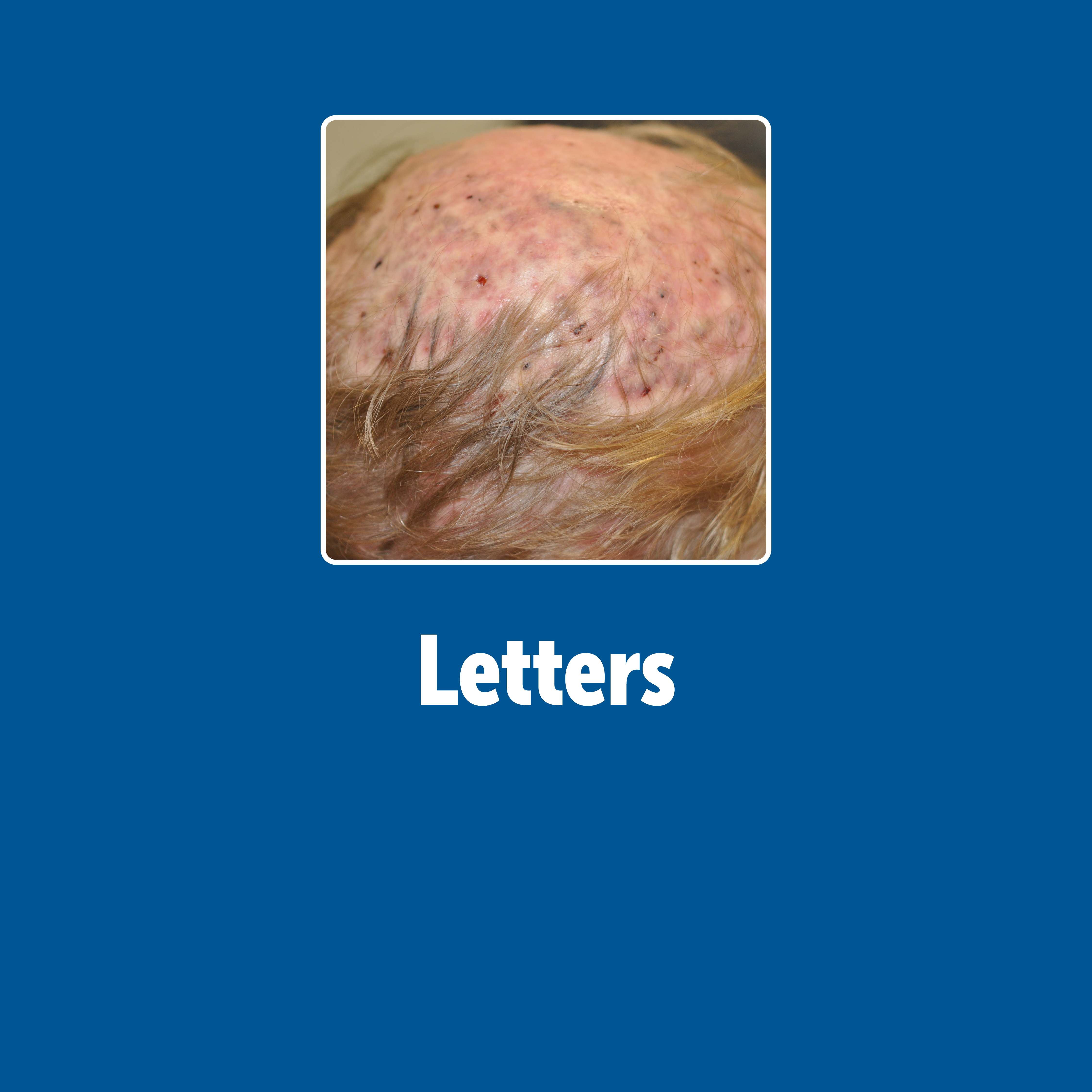 Case Report: Tinea Capitis in a 10-Year-Old Child | AFP