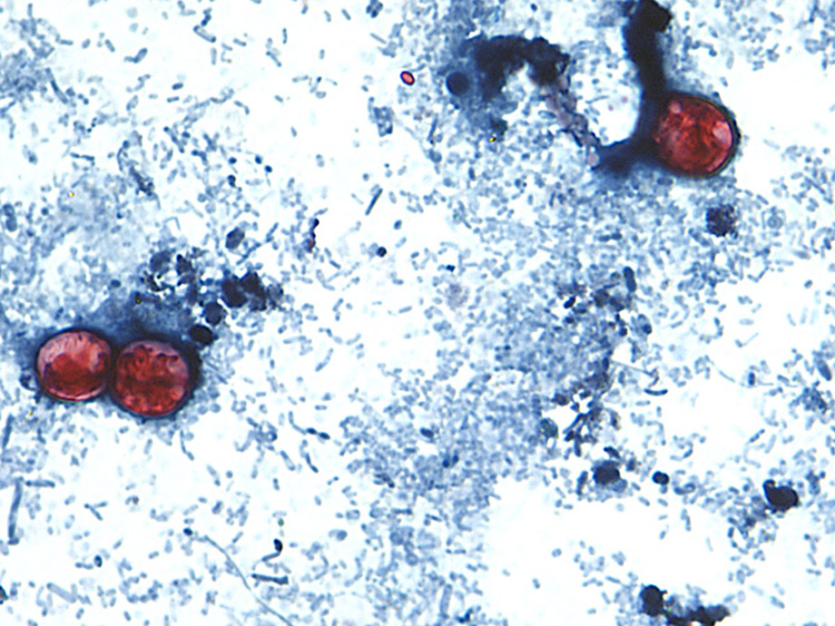 Cyclosporiasis Cases on Upswing, Warns CDC Health Advisory