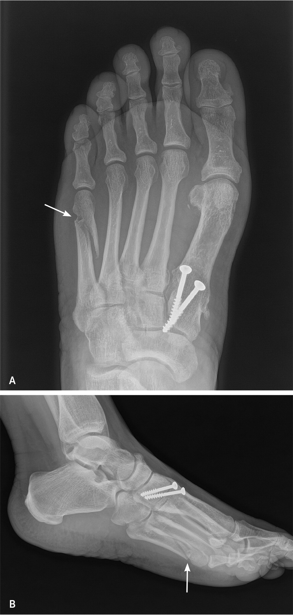 Common Foot Fractures | AAFP