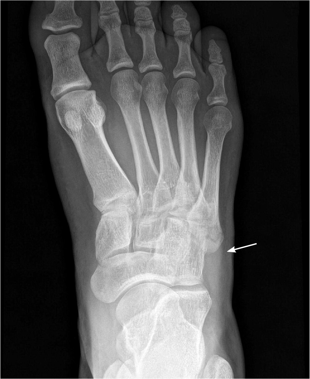 Common Foot Fractures | AAFP