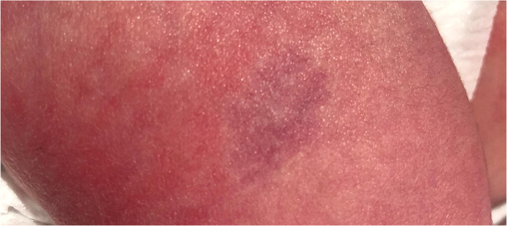 Newborn Skin: Part II. Birthmarks | AAFP