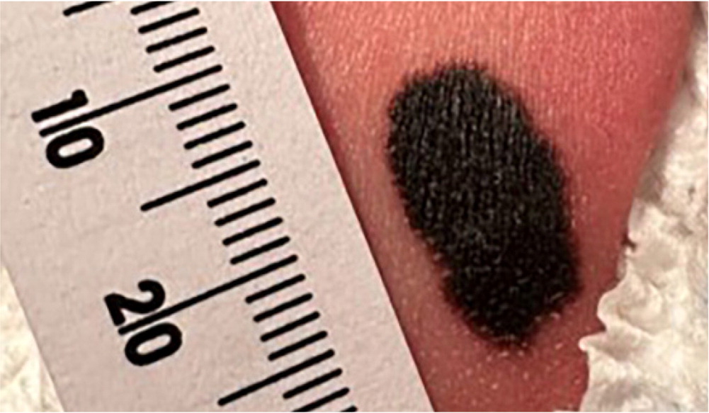 Newborn Skin: Part II. Birthmarks | AAFP