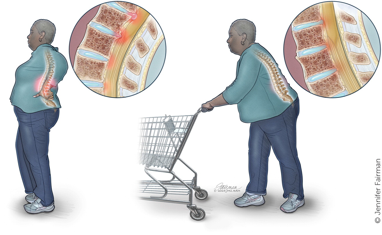 Lumbar Spinal Stenosis: Diagnosis and Management | AAFP