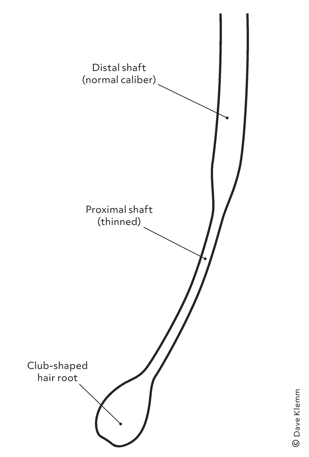 Hair Loss: Diagnosis and Treatment | AAFP