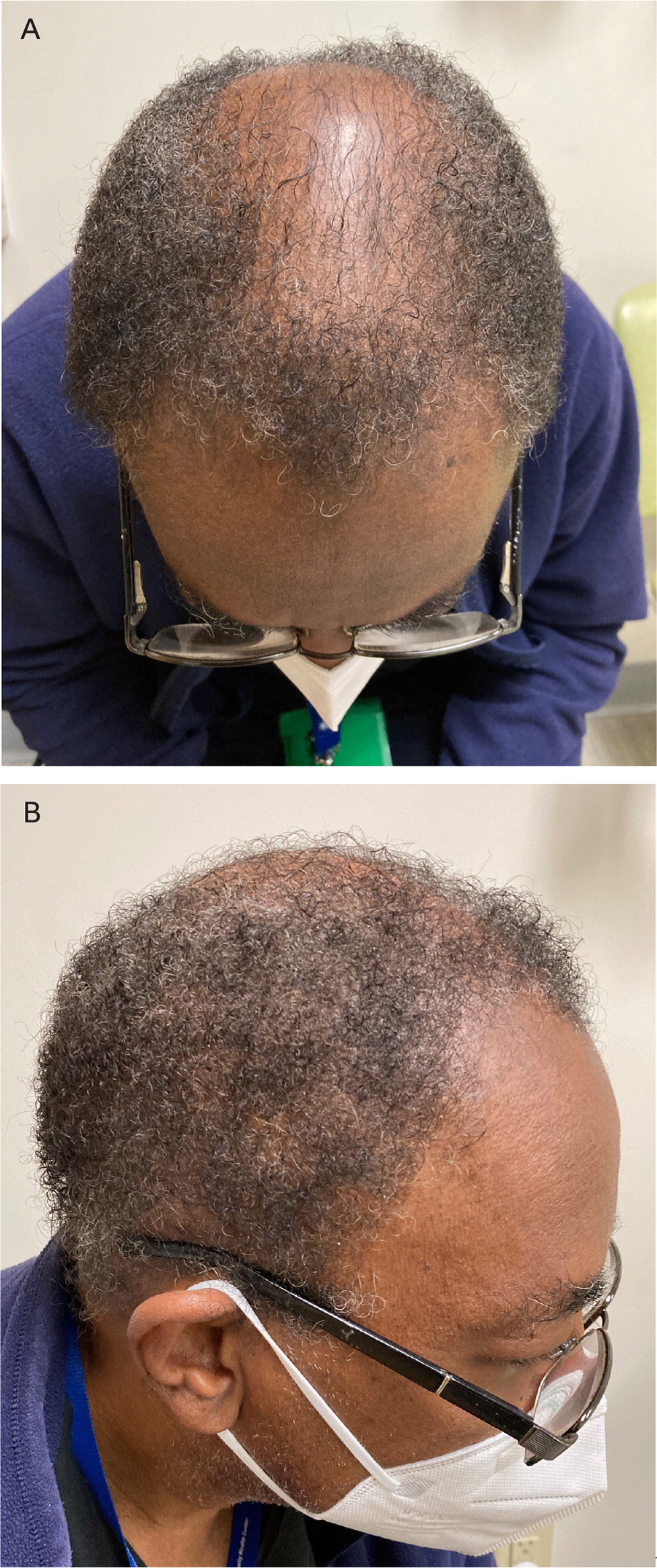 Hair Loss: Diagnosis and Treatment | AAFP