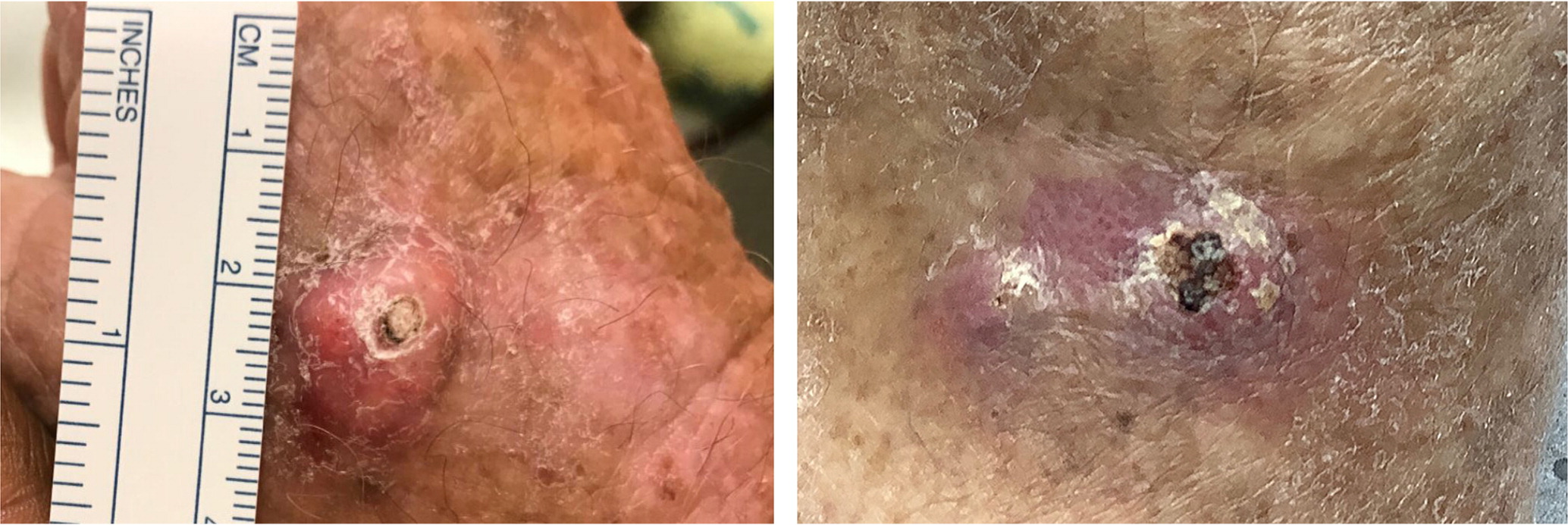 Diagnosing Common Benign Skin Tumors | AAFP