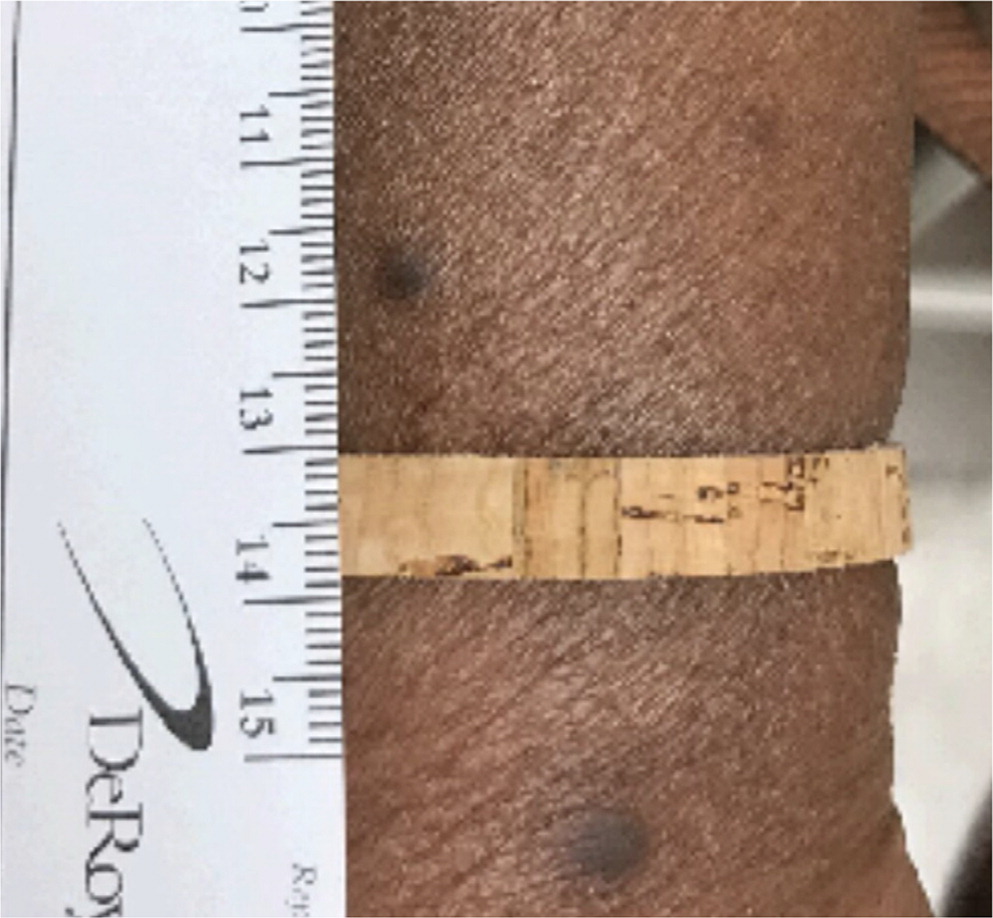 Diagnosing Common Benign Skin Tumors | AAFP