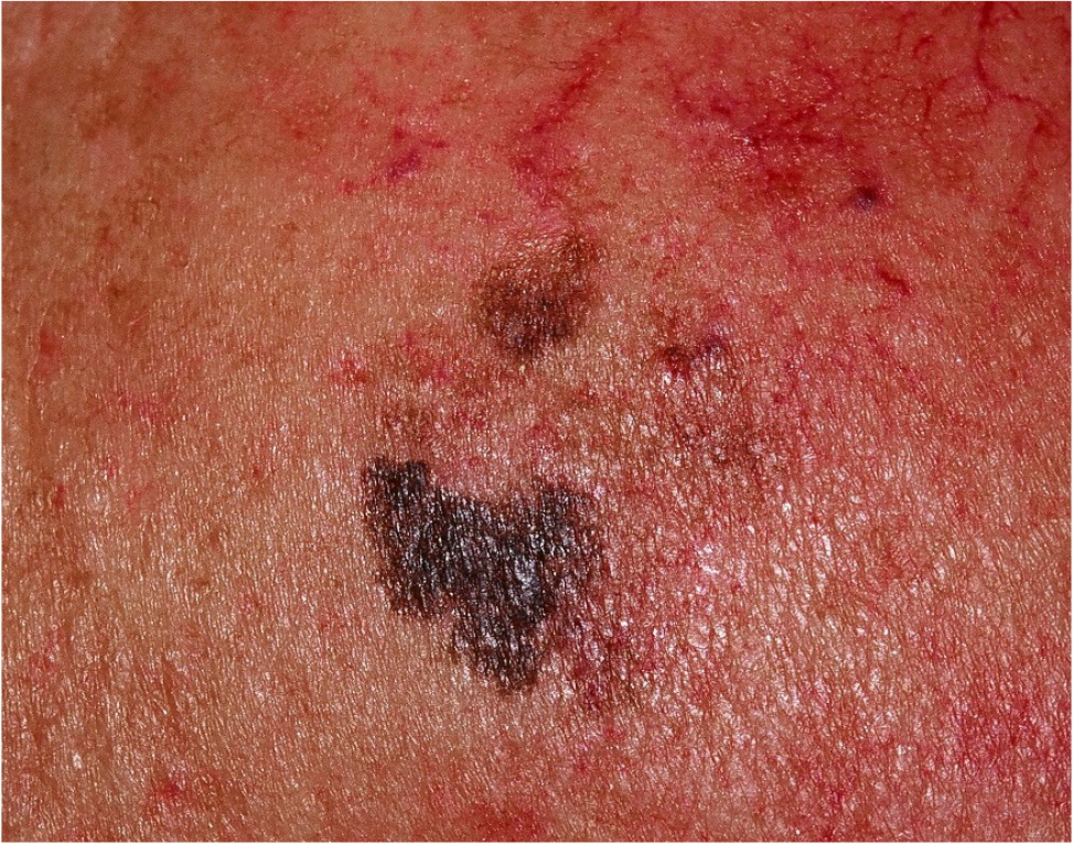 Melanoma: Diagnosis and Treatment | AAFP