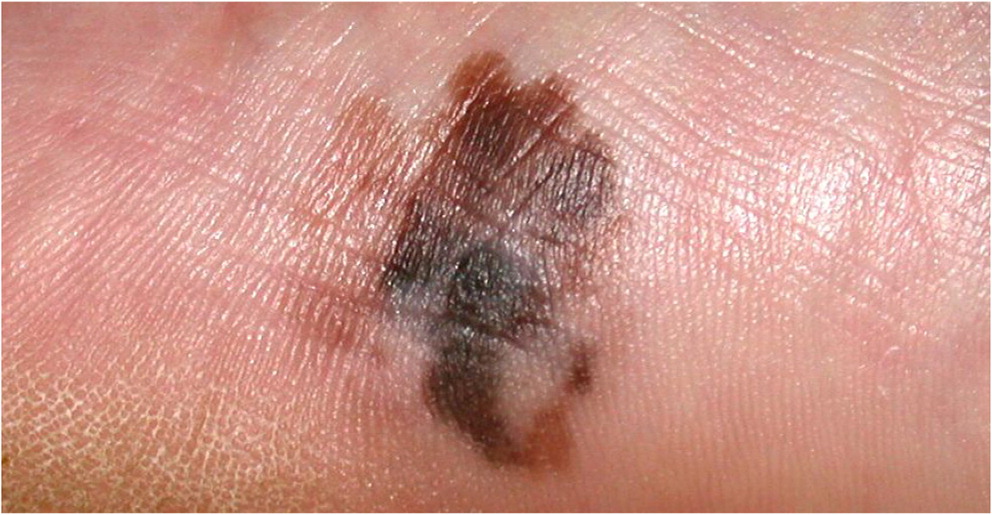 Melanoma: Diagnosis and Treatment | AAFP