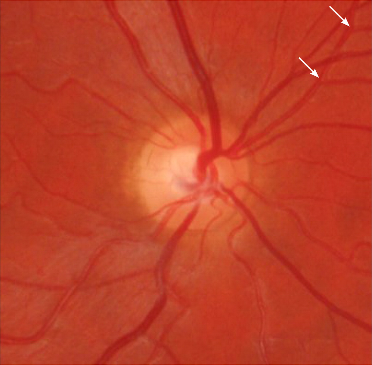 Sudden Vision Loss: A Diagnostic Approach | AAFP