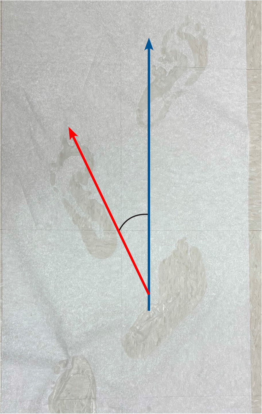 Lower Extremity Abnormalities in Children | AAFP