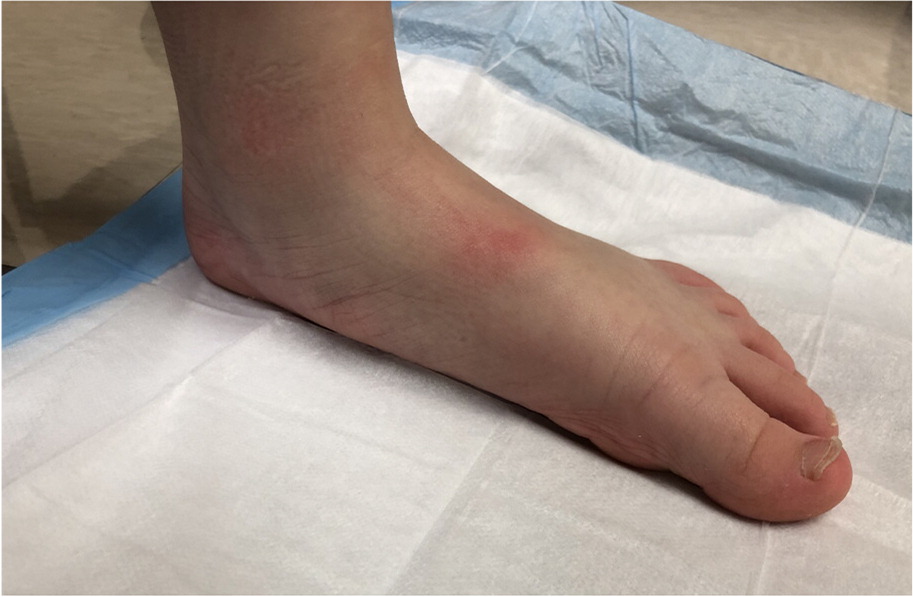 Lower Extremity Abnormalities in Children | AAFP