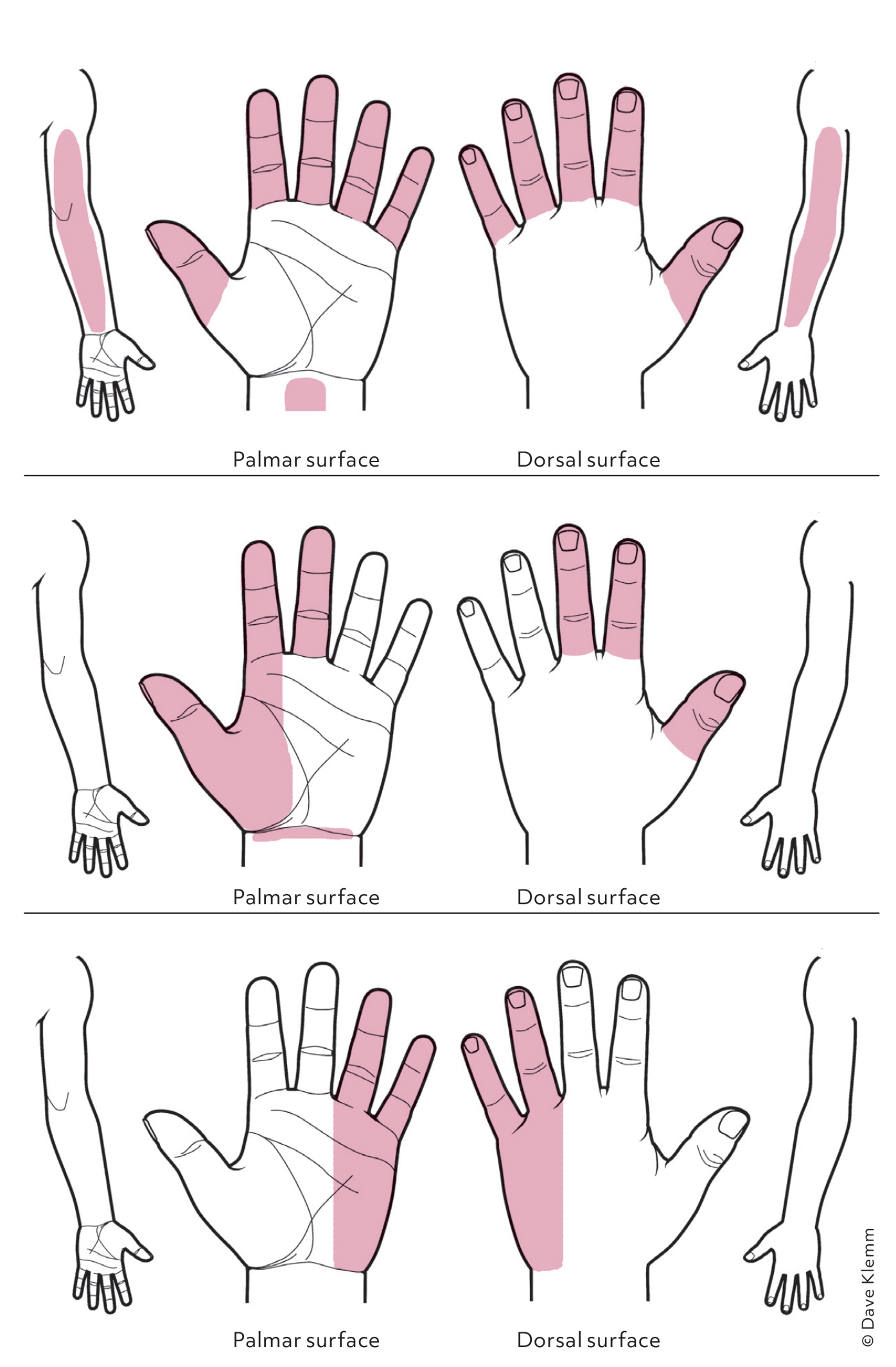 Common Occupational Upper Extremity Musculoskeletal Disorders | AAFP