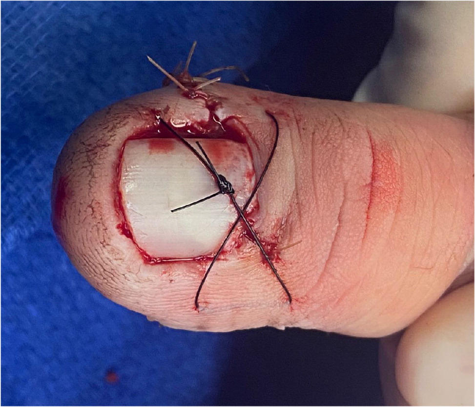 Fingertip Injuries | AAFP