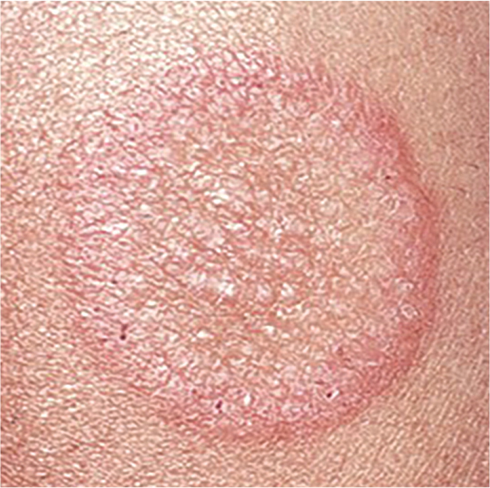 Diagnosis and Management of Tinea Infections | AAFP