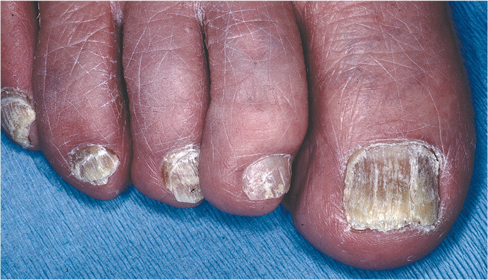 Diagnosis and Management of Tinea Infections | AAFP