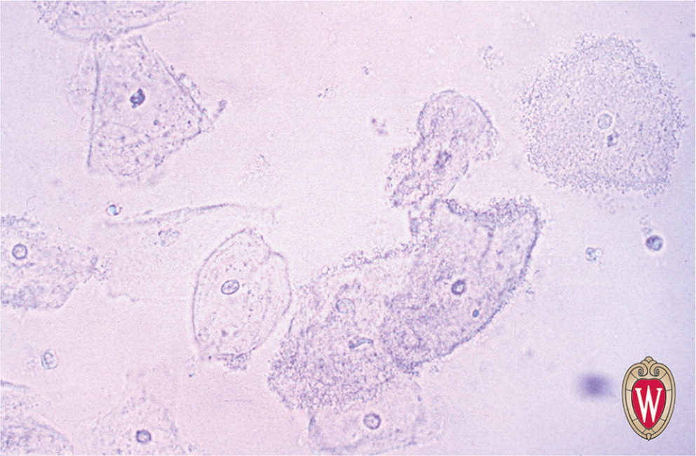 Vaginitis: Diagnosis and Treatment | AAFP