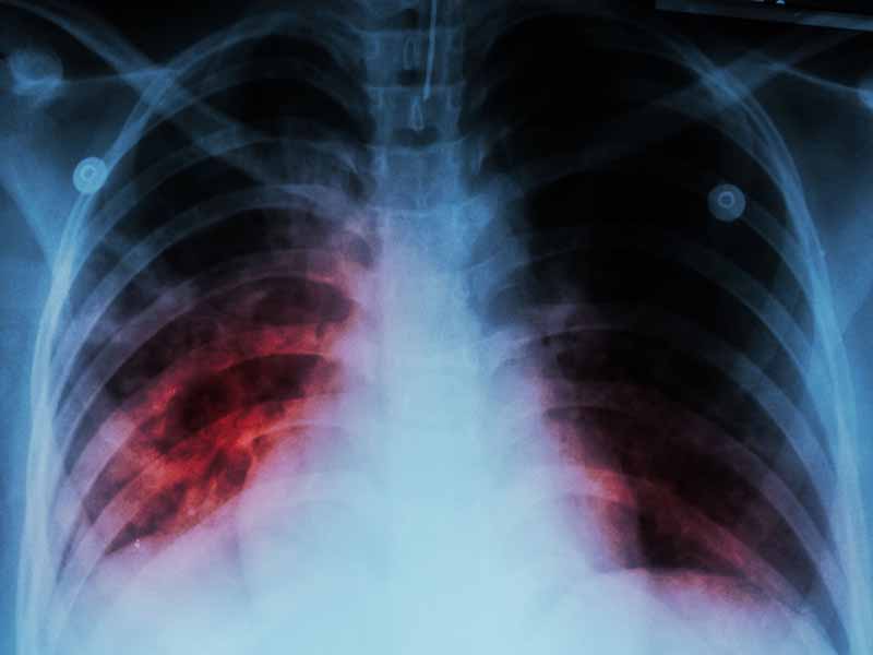 CDC Updates Latent TB Infection Treatment Recommendations | AAFP