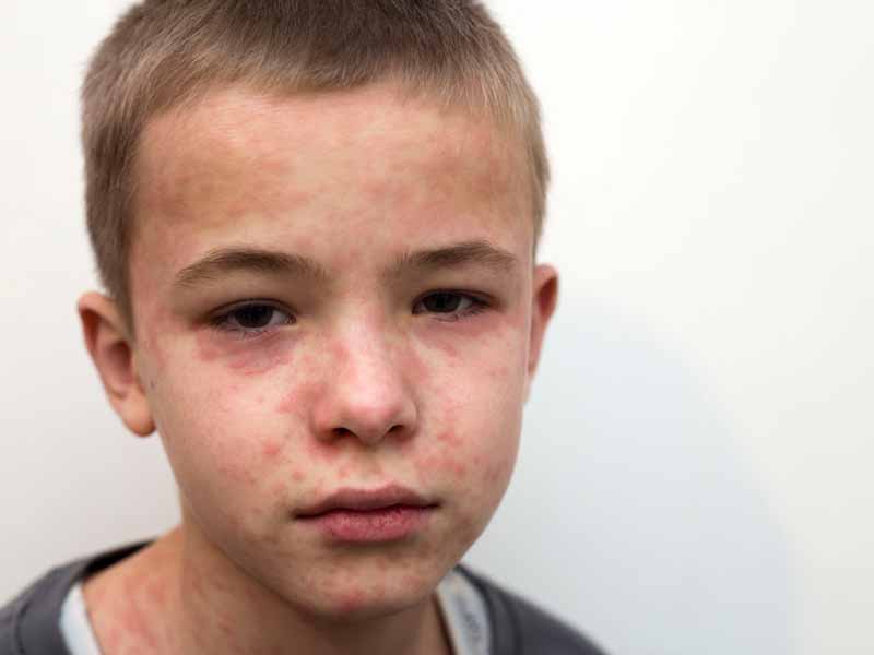 Measles Face