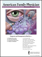 Perilimbic Sparing Conjunctivitis