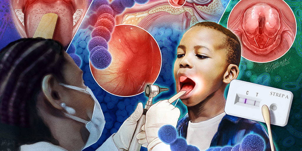 Antibiotic Use in Acute Upper Respiratory Tract Infections | AAFP