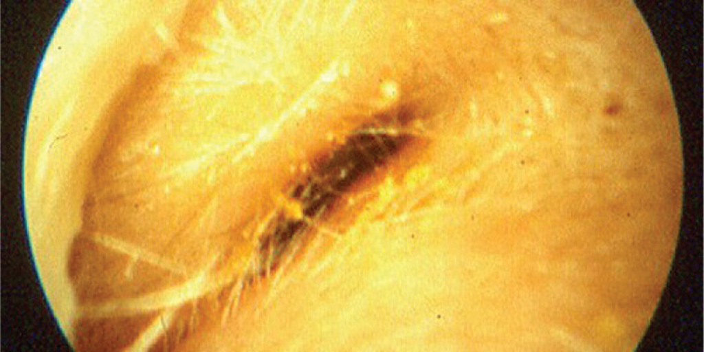 Acute Otitis Externa: Rapid Evidence Review | AAFP