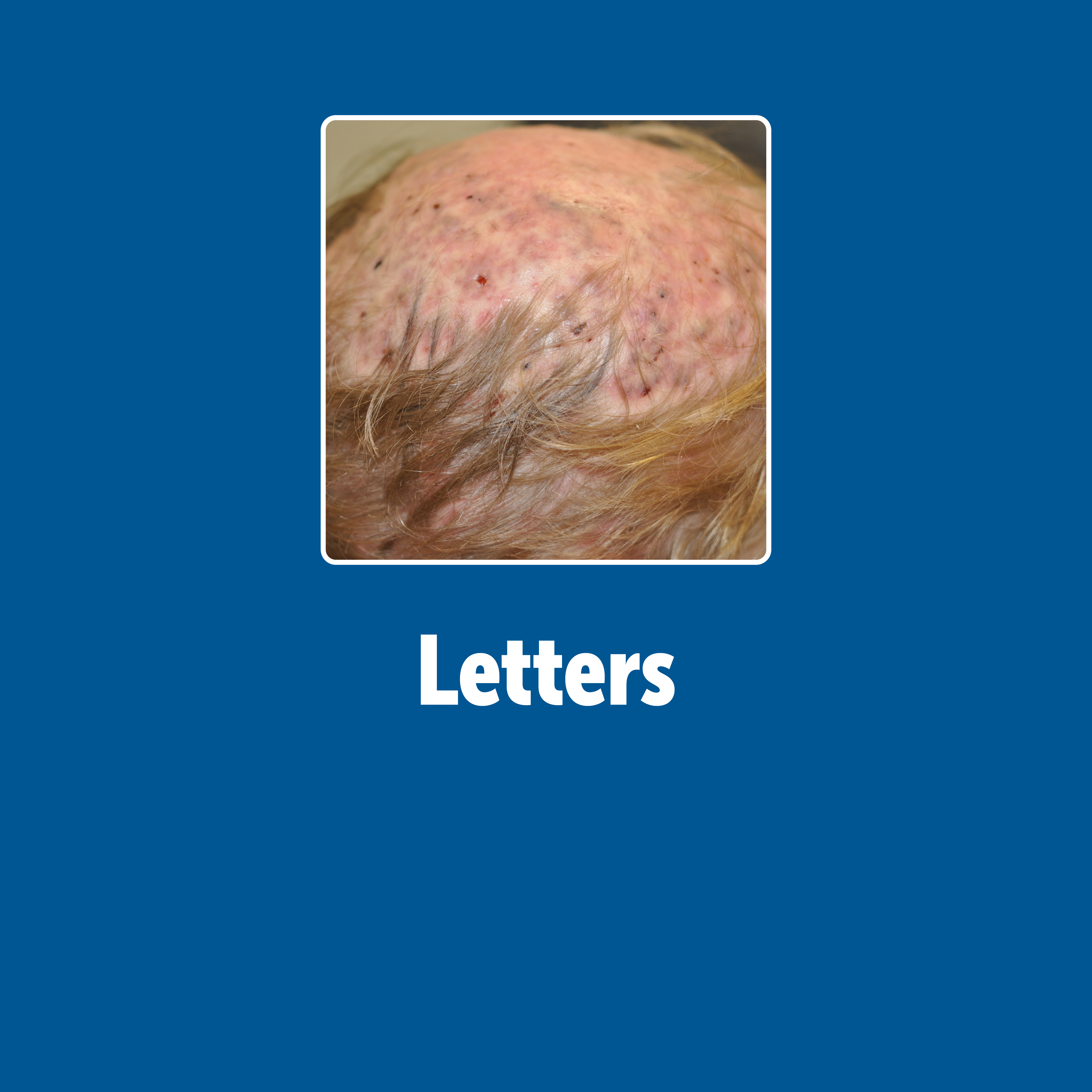 Case Report: Tinea Capitis in a 10-Year-Old Child | AAFP