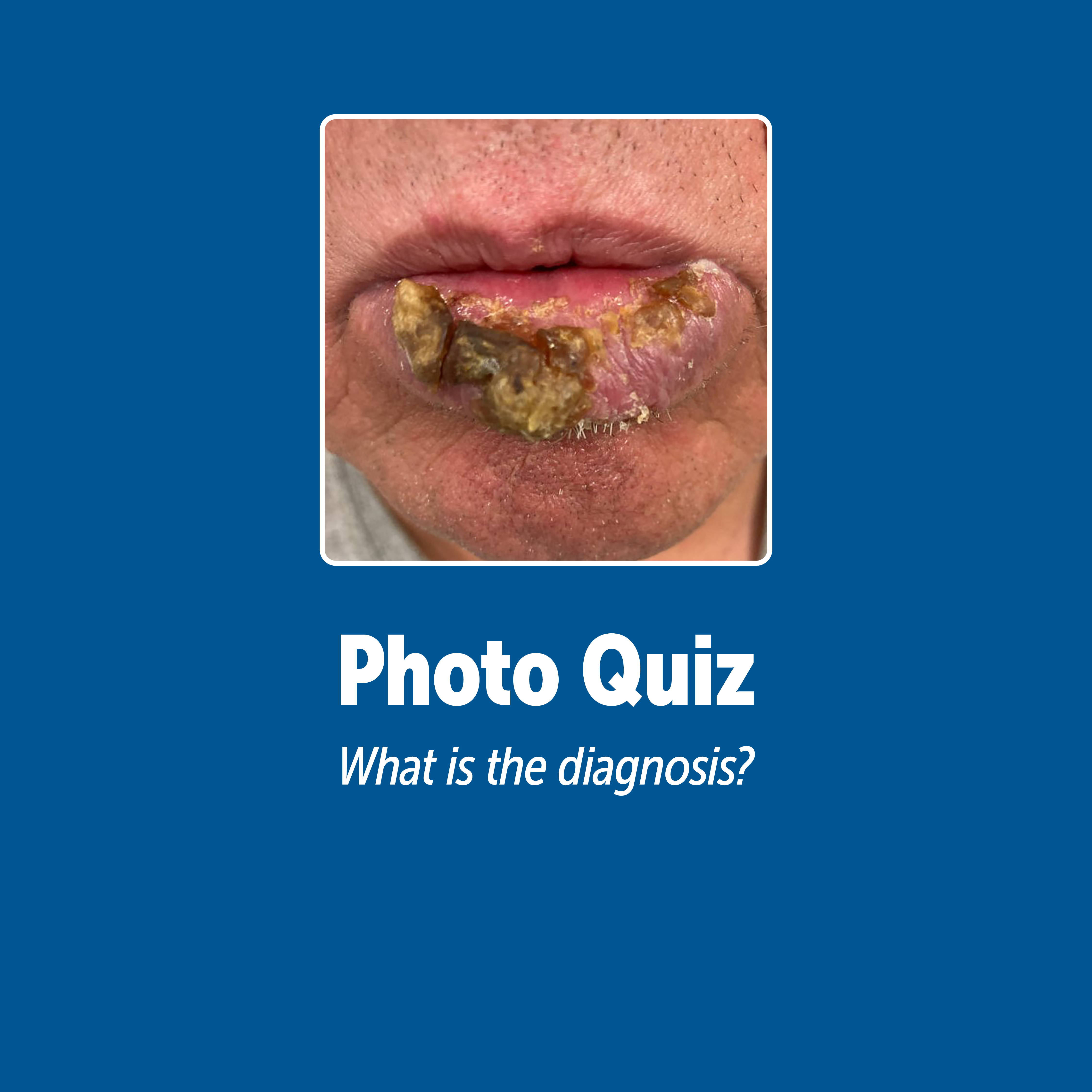 Suspicious Lesion Under a Face Mask | AAFP