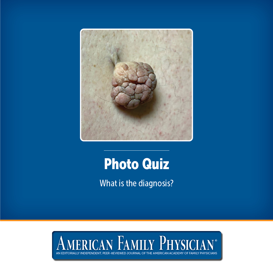 Large Skin Growth in a Middle-Aged Man | AAFP