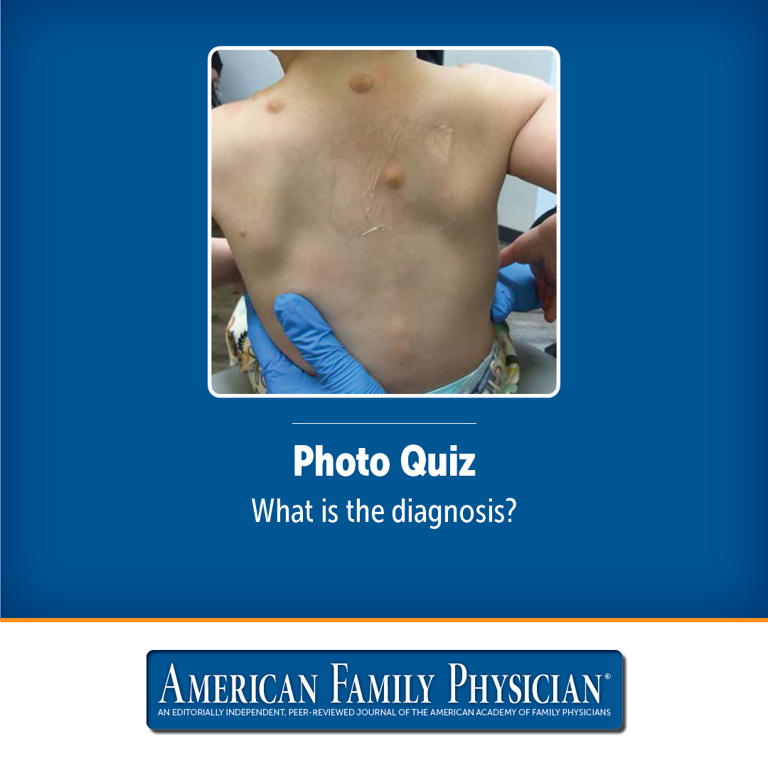 An Infant With Widespread Nodules and Papules | AAFP