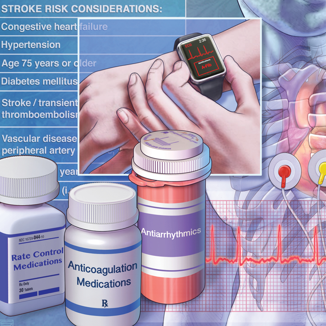 Atrial Fibrillation: Common Questions and Answers About Diagnosis and ...
