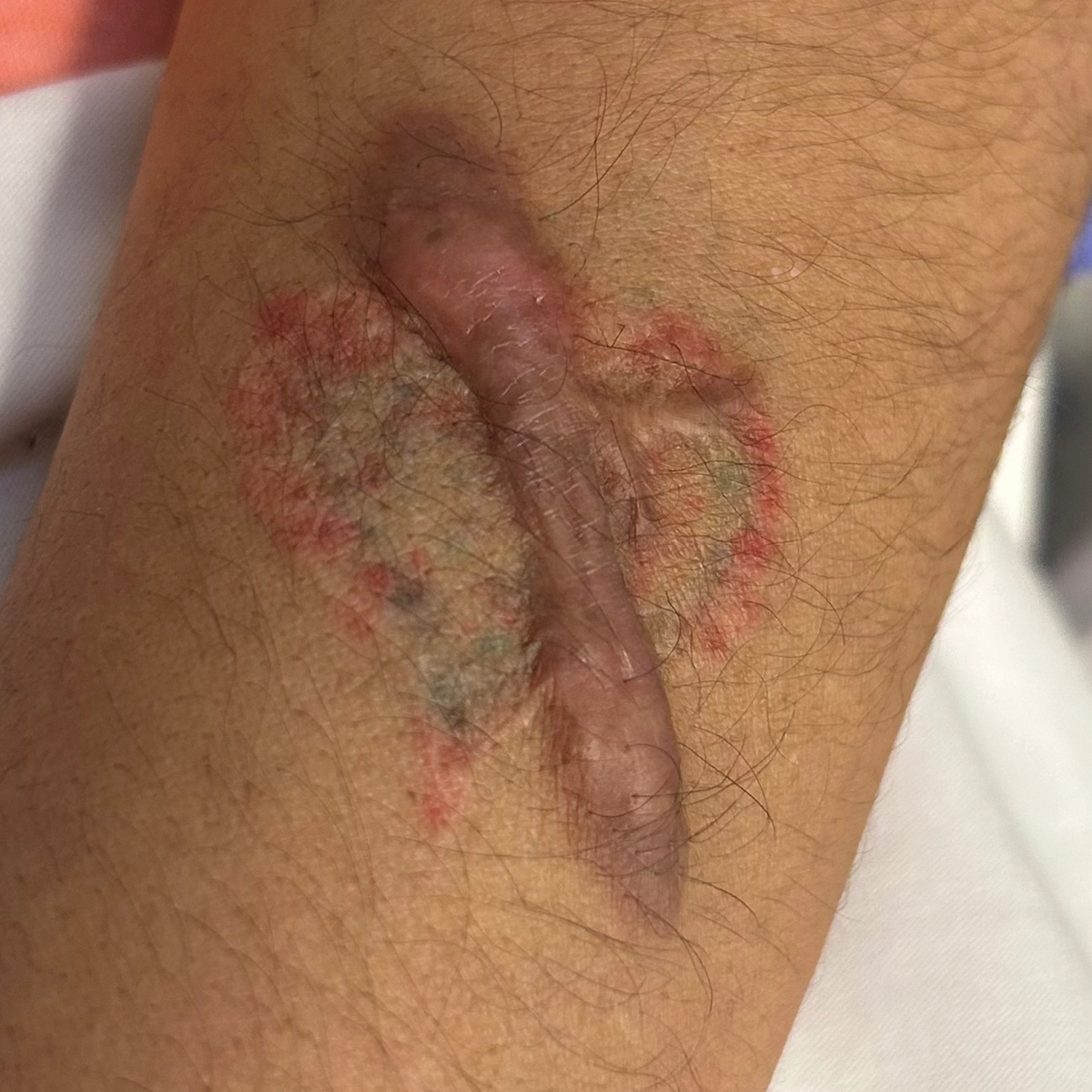 Scar Keloid Pollta Srón Intense Pulsed Light In The Management Of
