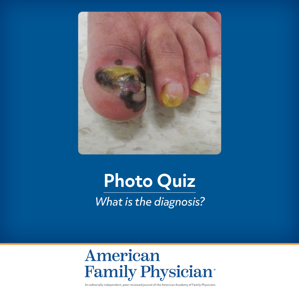 Painless Black Toe | AAFP