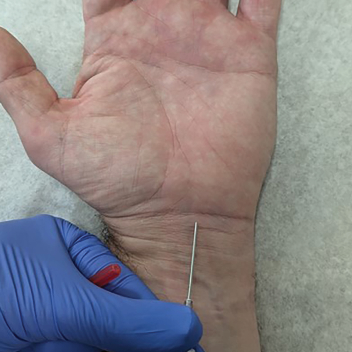 Common Occupational Upper Extremity Musculoskeletal Disorders | AAFP