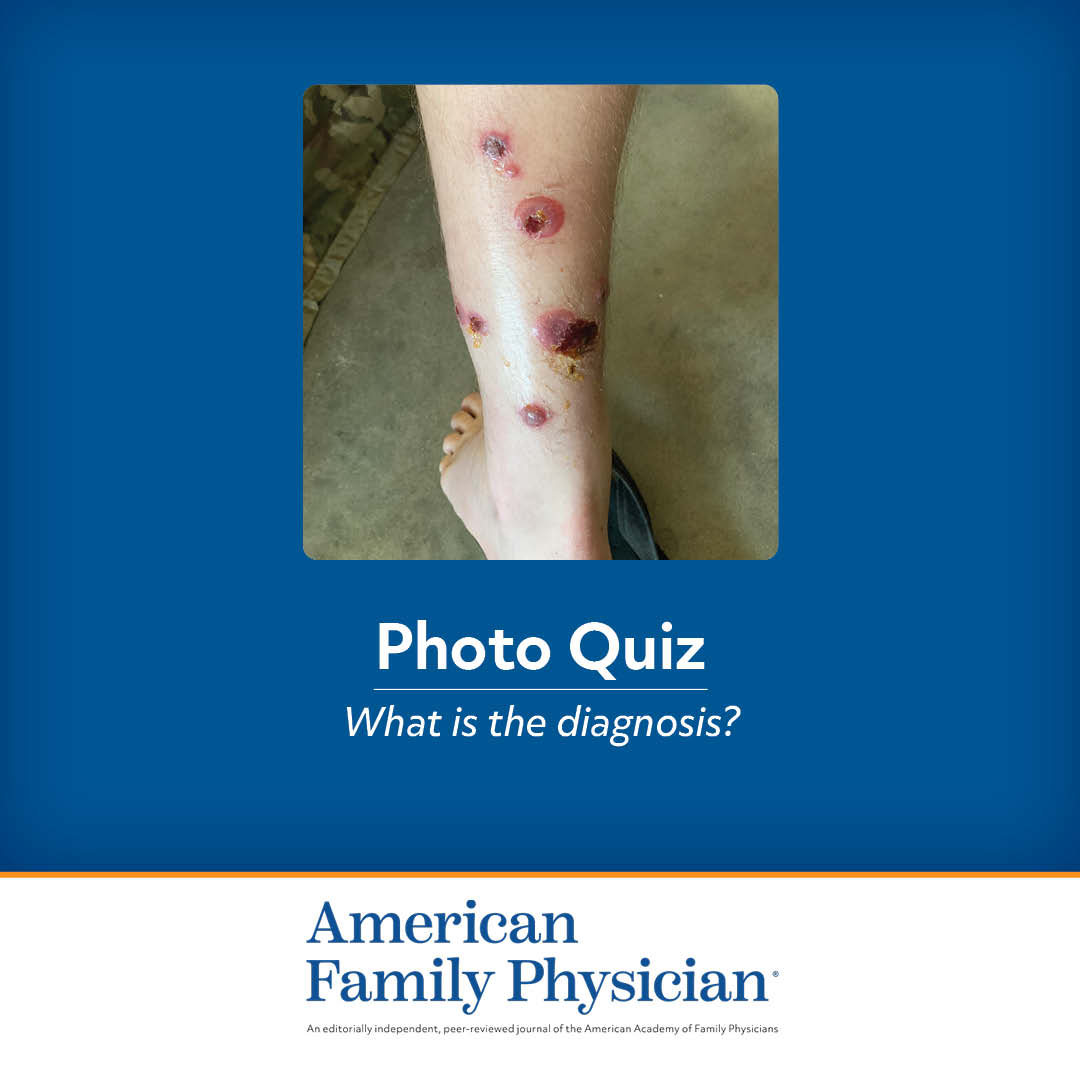 Bullous Rash on the Legs | AAFP