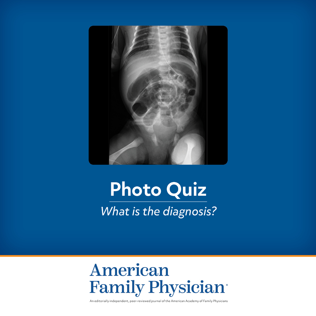 Newborn With Enlarged Bowel | AAFP