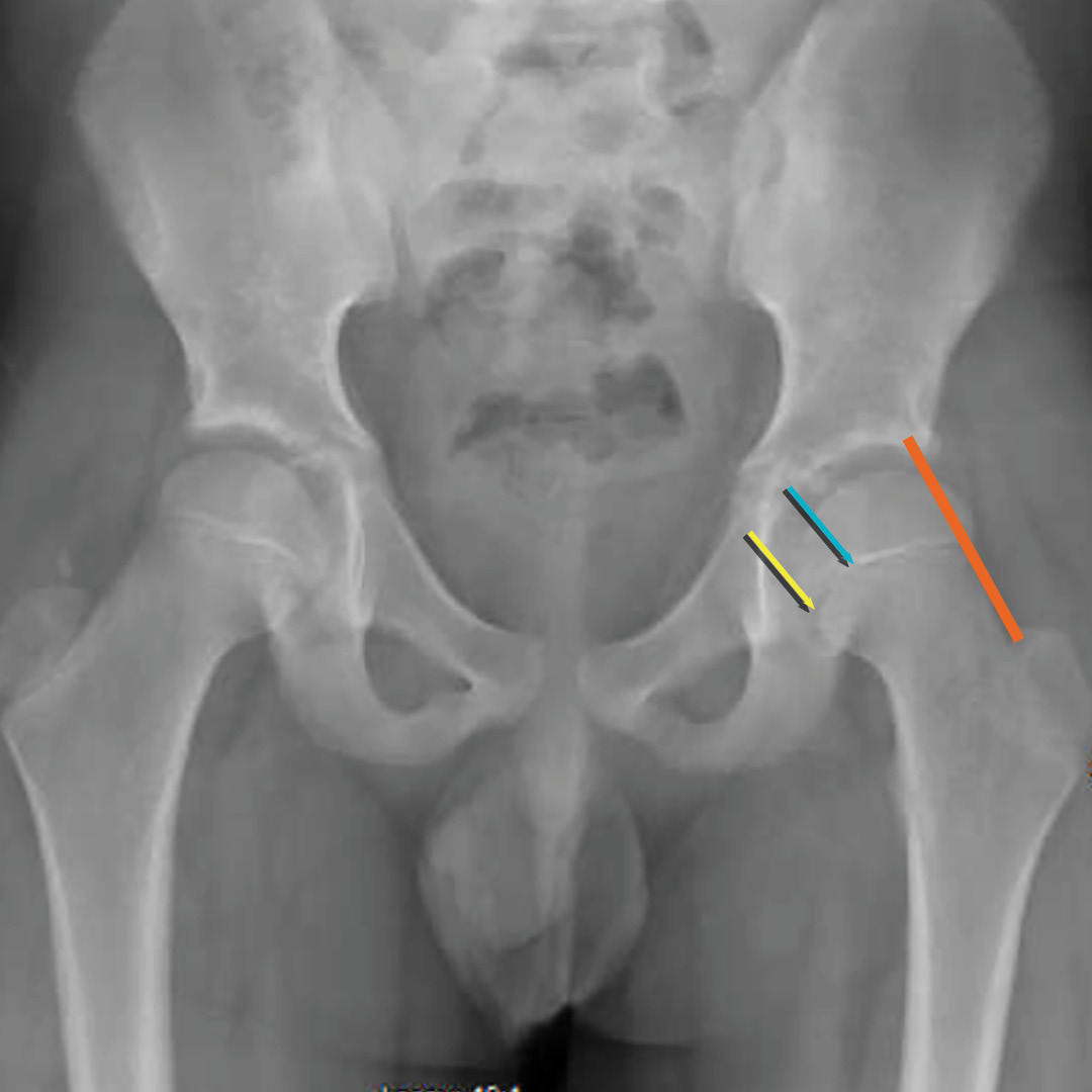 Slipped Capital Femoral Epiphysis: Rapid Evidence Review | AAFP