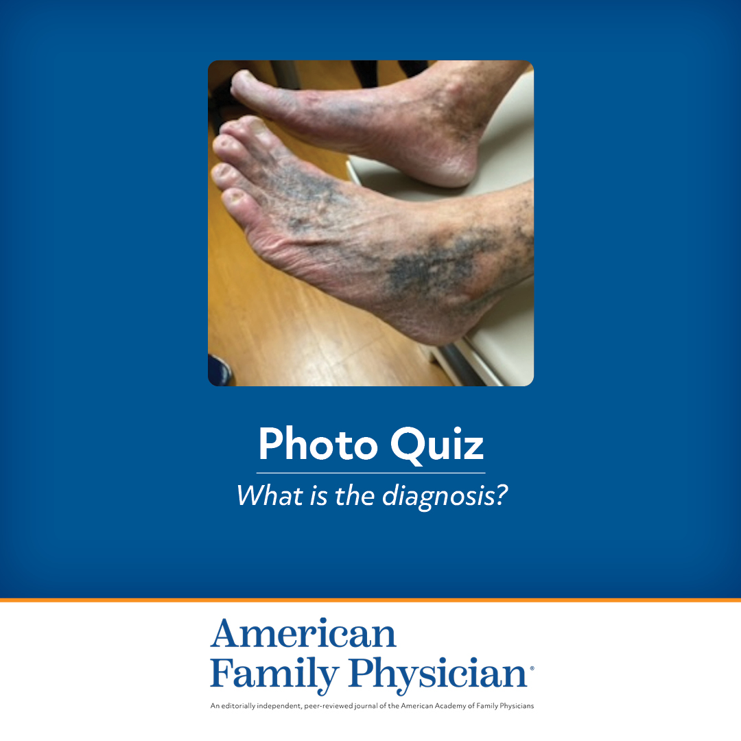 Progressive Skin Discoloration | AAFP